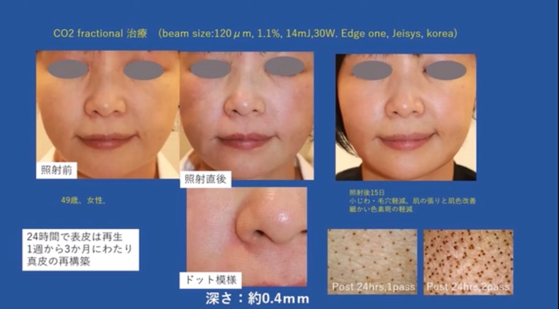 Our Experience and Cases with the Edge ONE Fractional Mode CO2 Laser ...