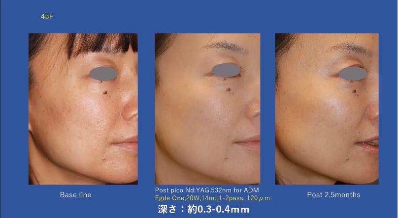 Our Experience and Cases with the Edge ONE Fractional Mode CO2 Laser ...