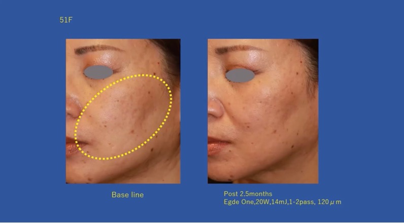 Our Experience and Cases with the Edge ONE Fractional Mode CO2 Laser ...