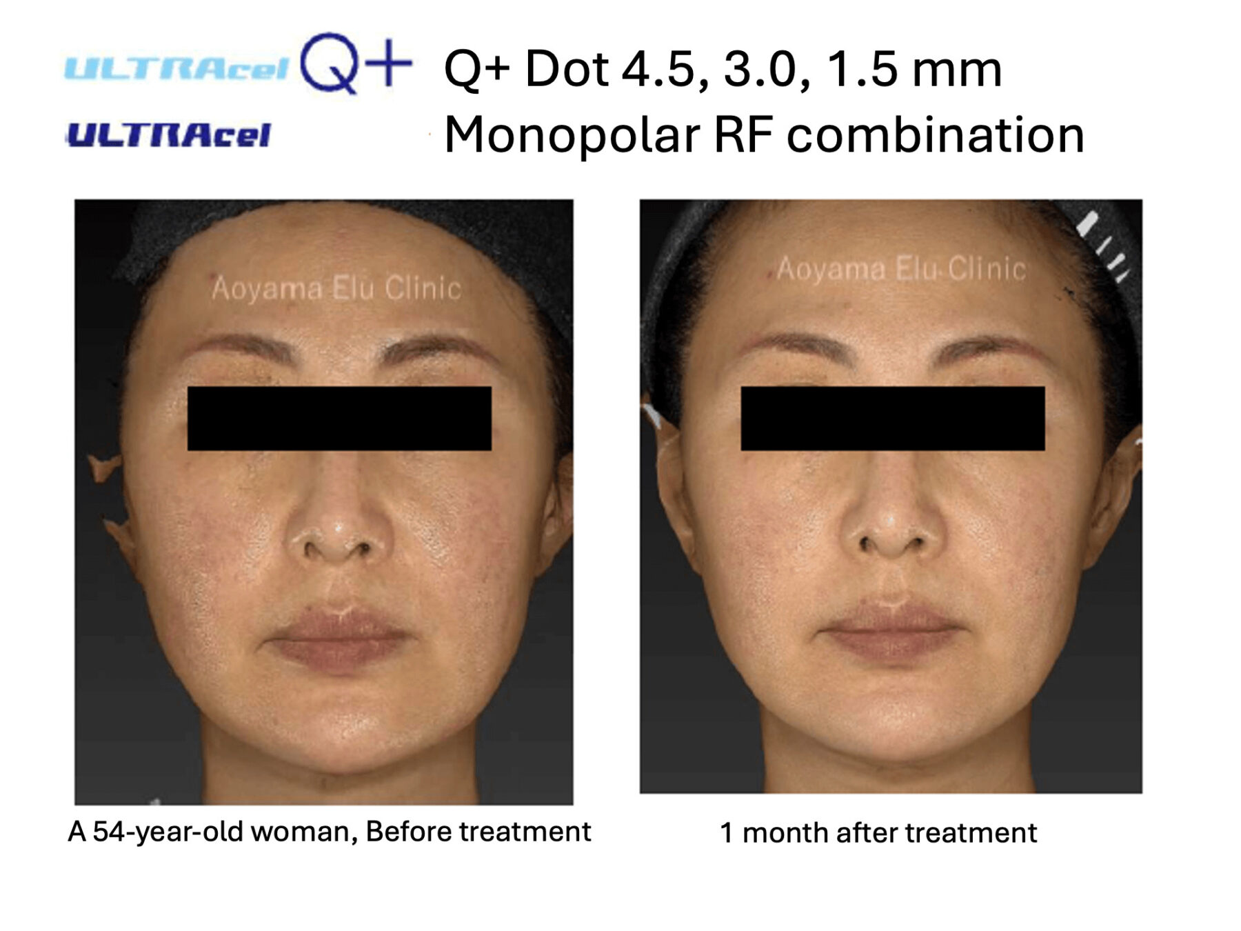 Premium HIFU Treatment with ‘ULTRAcel [zíː]’ | Clinician’s REPORT | Jeisys