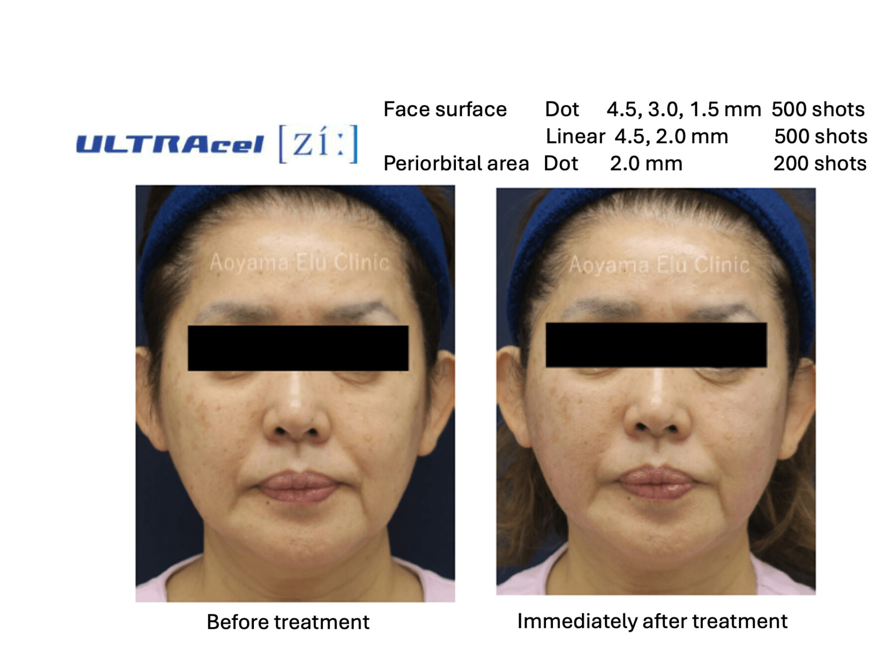 Premium HIFU Treatment with ‘ULTRAcel [zíː]’ | Clinician’s REPORT | Jeisys