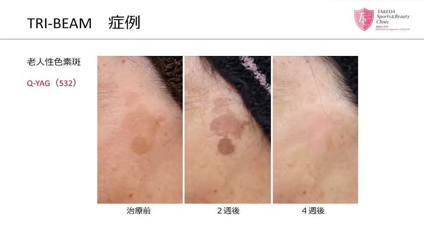 TRI-BEAM, the device that has supported treatments from our clinic’s ...