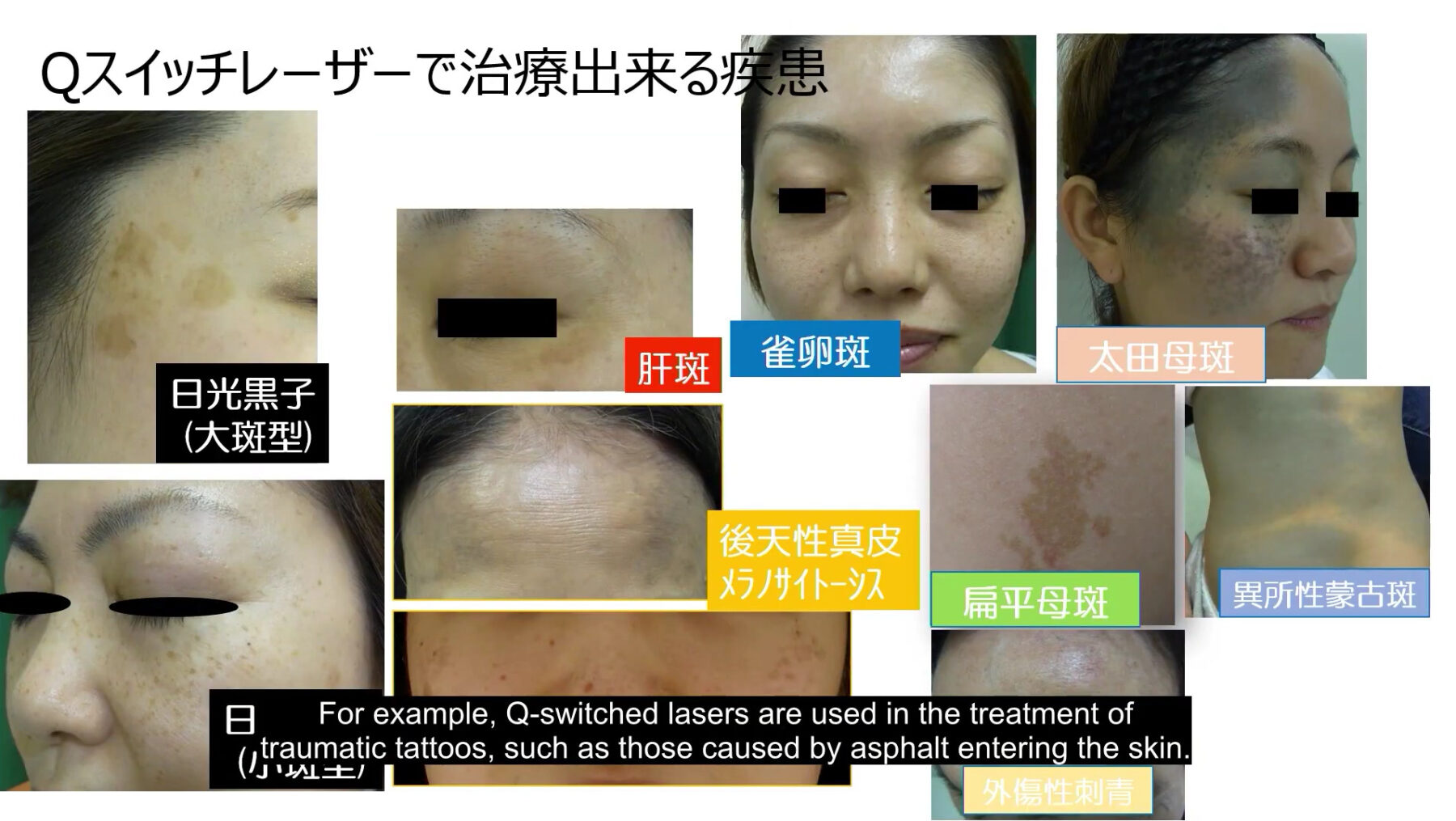 Rediscovering Q-Switched Lasers：Practical Approaches to Pigmented ...